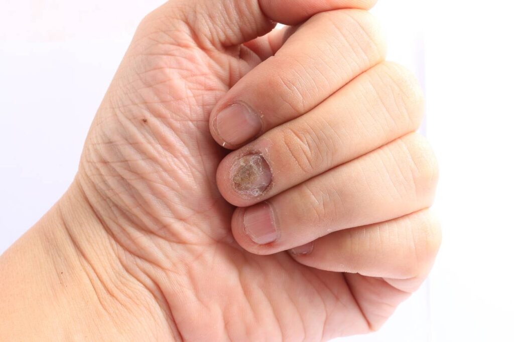 Comment traiter efficacement le psoriasis ongle ? - plare.