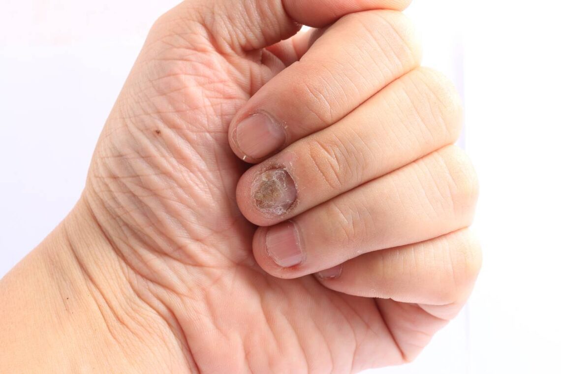 Comment traiter efficacement le psoriasis ongle ? - plare.